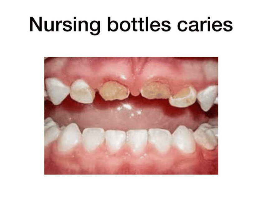 Nursing bottles caries | Parentune.com