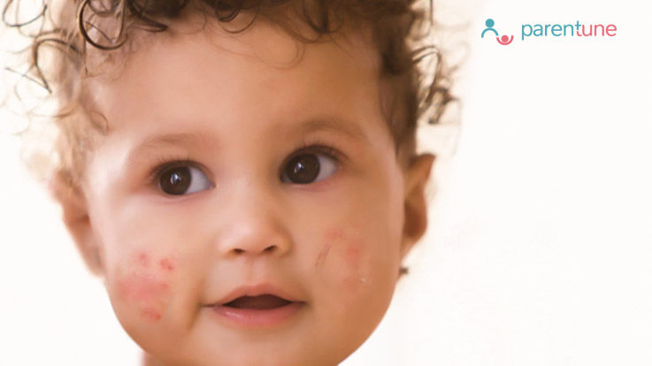 Baby Acne - Causes & Prevention Tips