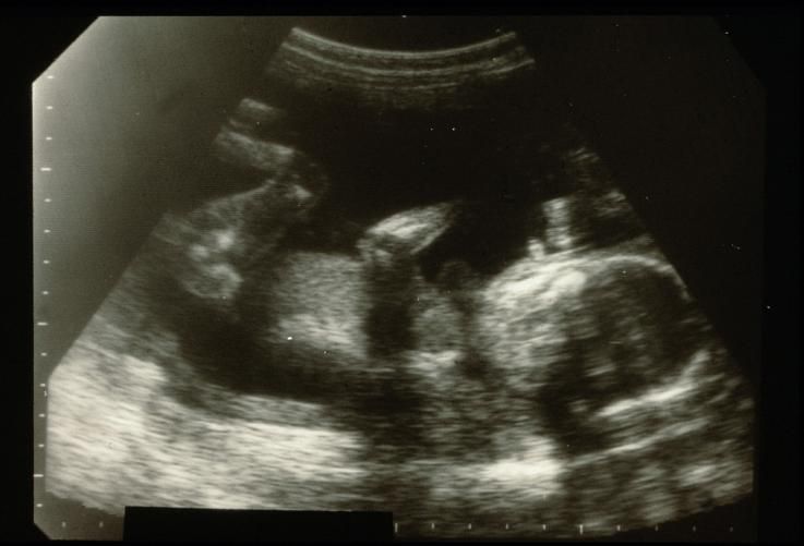 17 Weeks And 3 Days Pregnant Baby Fetal Progress Ultrasound 