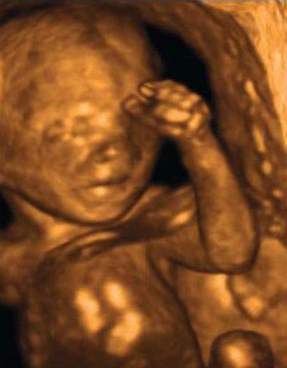 17 Weeks And 5 Days Pregnant Baby Fetal Progress Ultrasound 