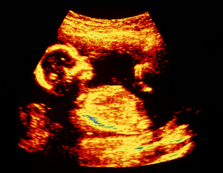 18 weeks and 4 days pregnant - Baby Fetal Progress, Ultrasound ...