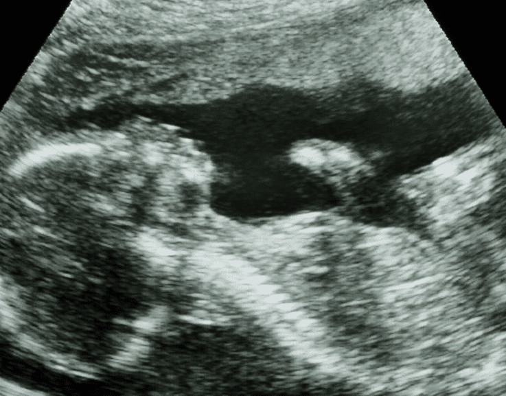 22 weeks and 4 days pregnant - Baby Fetal Progress, Ultrasound ...